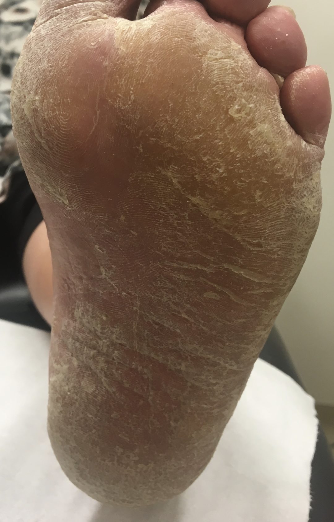 Stop Itching: Tinea Treatment at Holistic Foot Clinic